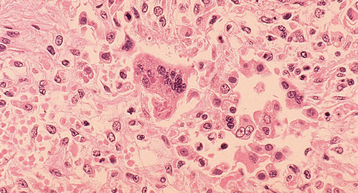 Unvaccinated Children at Risk for Measles, Stress Scientists | Microbiology